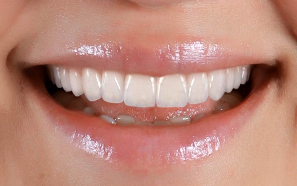 Informative Things One Should Know About Full Mouth Reconstruction ...