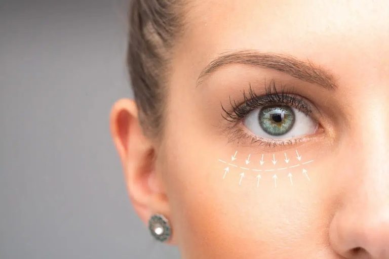 Non-Surgical Eye Bag Removal in Singapore: What You Need to Know ...